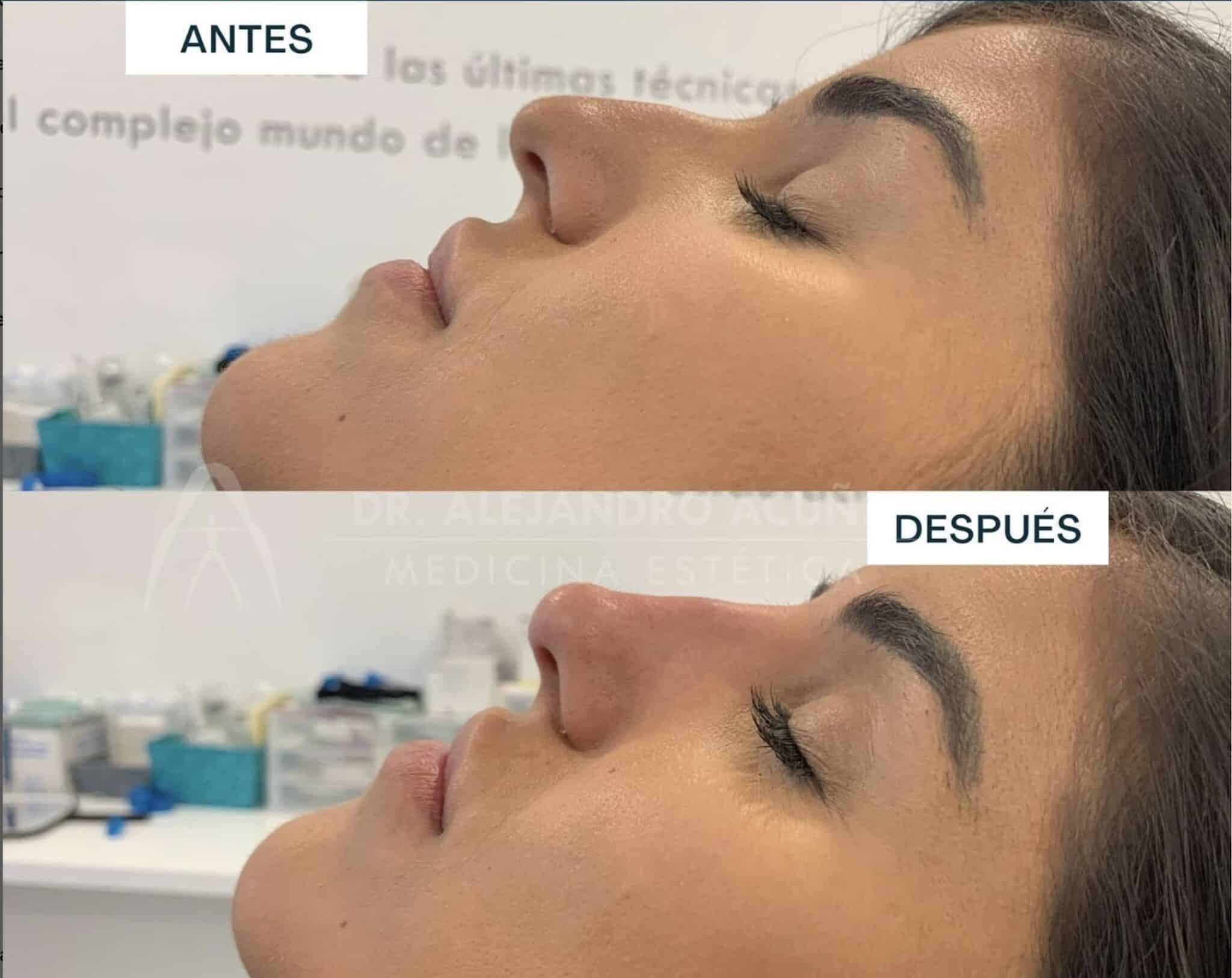 Rinomodelación guiada por ecografía - Dr. Alejandro Acuña